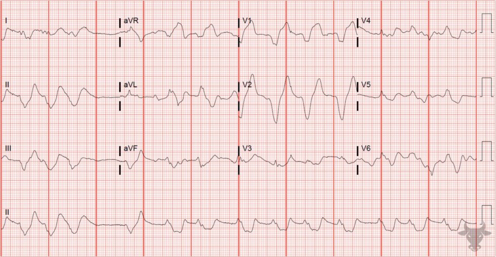 Hyperkalemia | ECG Stampede