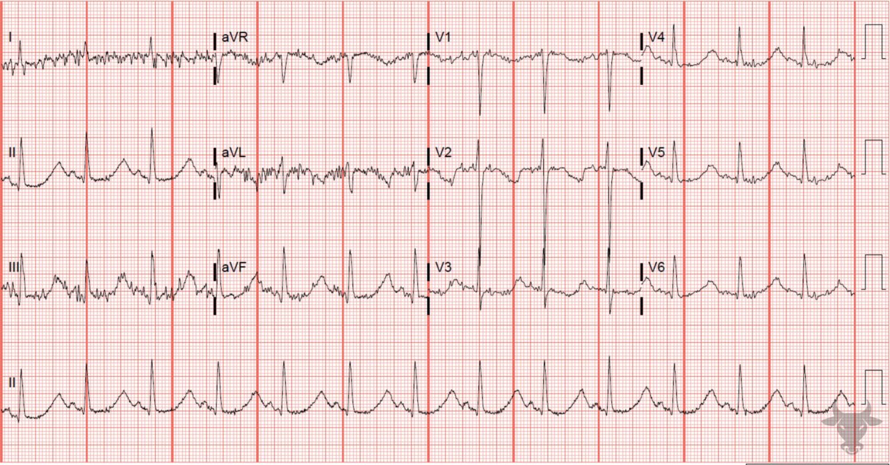 Prolonged QT | ECG Stampede