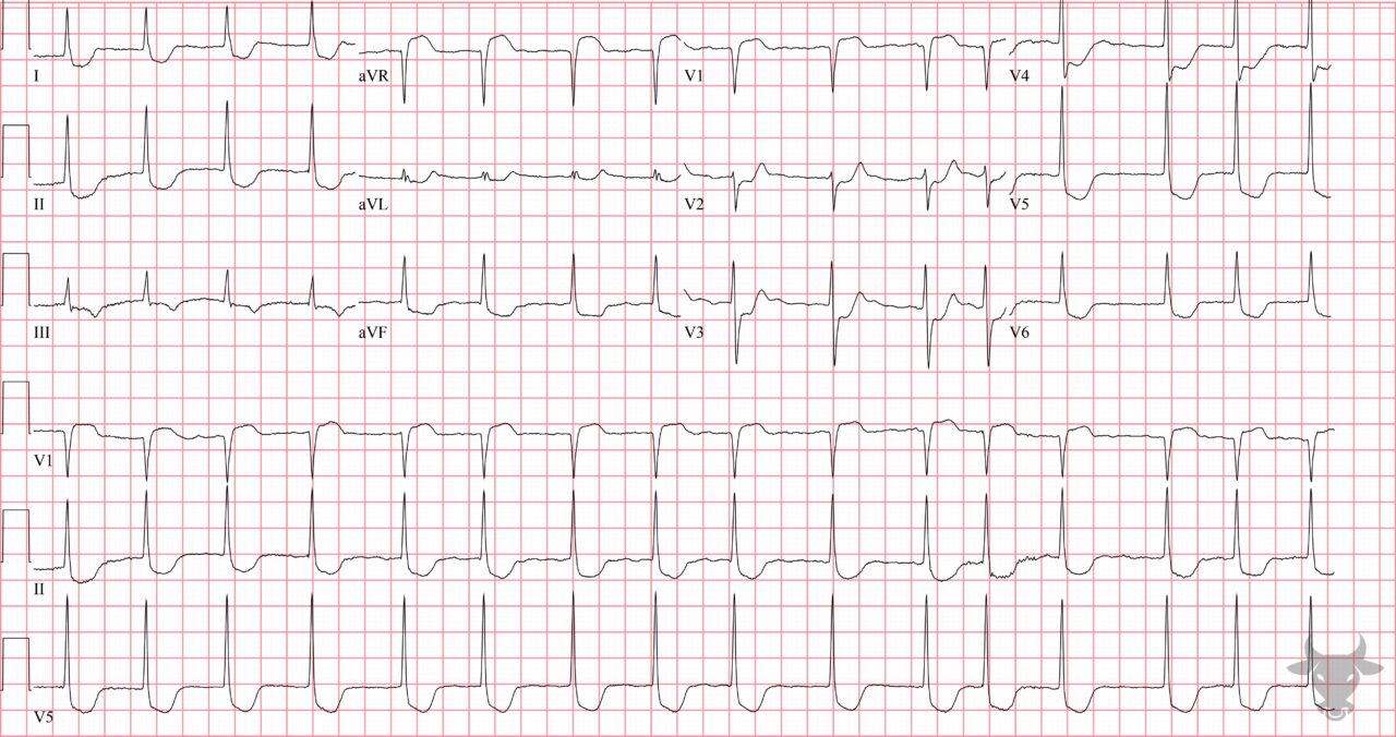Global Subendocardial Ischemia | ECG Stampede