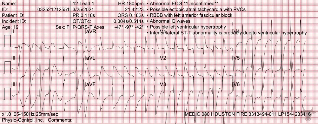 Ventricular Tachycardia | ECG Stampede