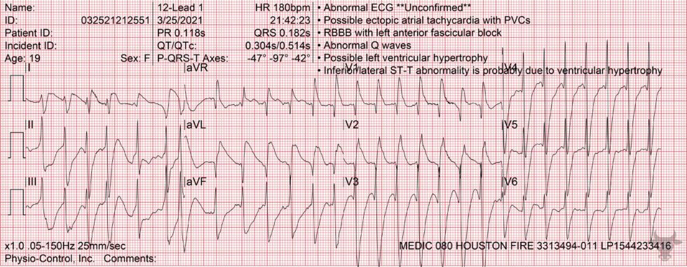 Ventricular Tachycardia | ECG Stampede