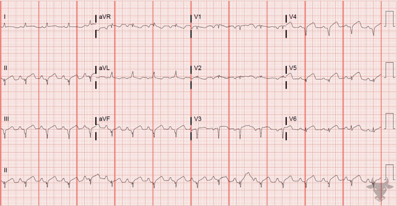 Hyperacute T Waves | ECG Stampede