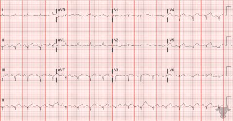 Hyperacute T Waves | ECG Stampede