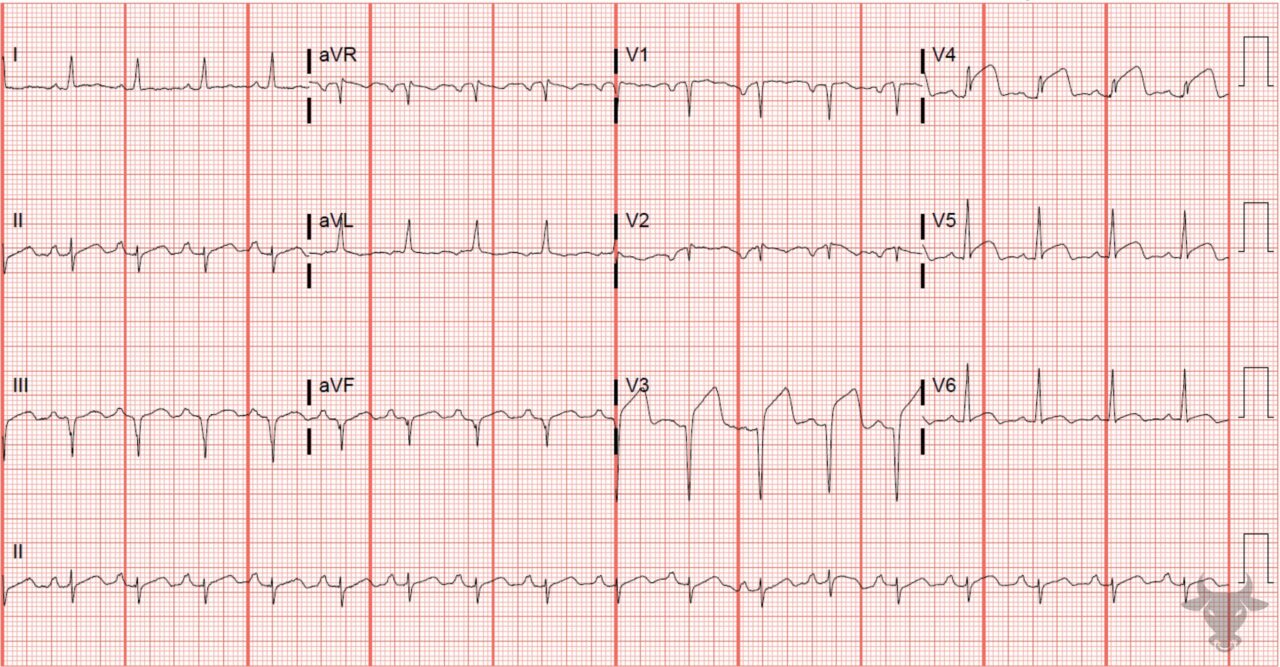 Poor R wave Progression ECG Stampede poor-r-wave-progression-ecg-stampede