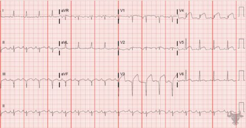 Poor R-wave Progression | ECG Stampede