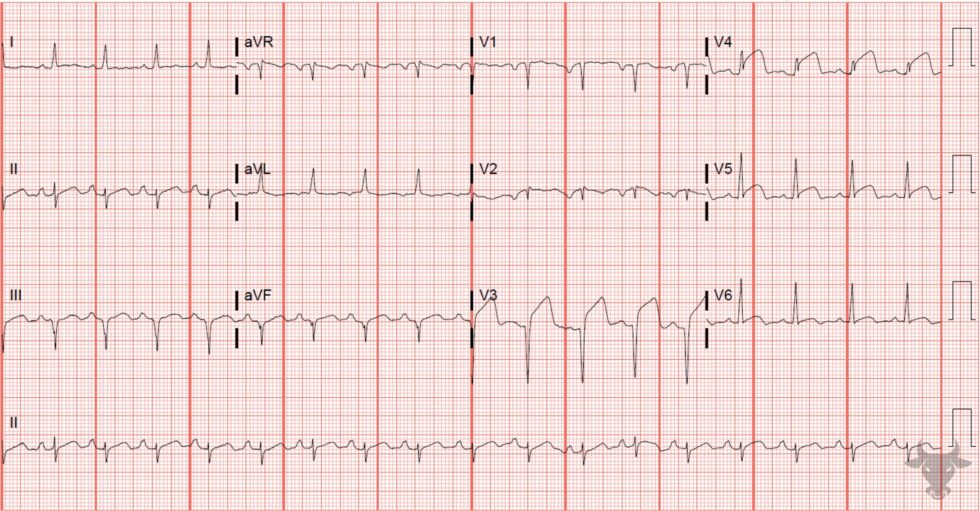 Poor R-wave Progression | ECG Stampede