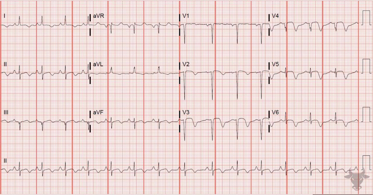 Wellens Syndrome | ECG Stampede