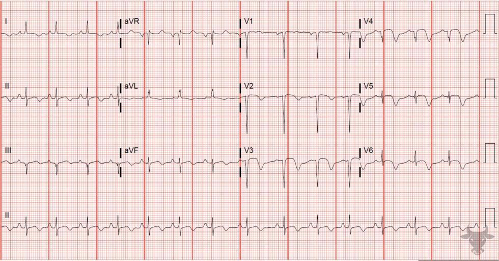 Wellens Syndrome | ECG Stampede