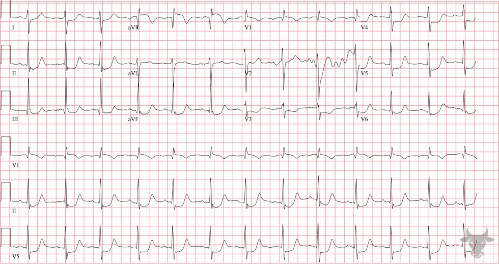 Global Subendocardial Ischemia Ecg Stampede