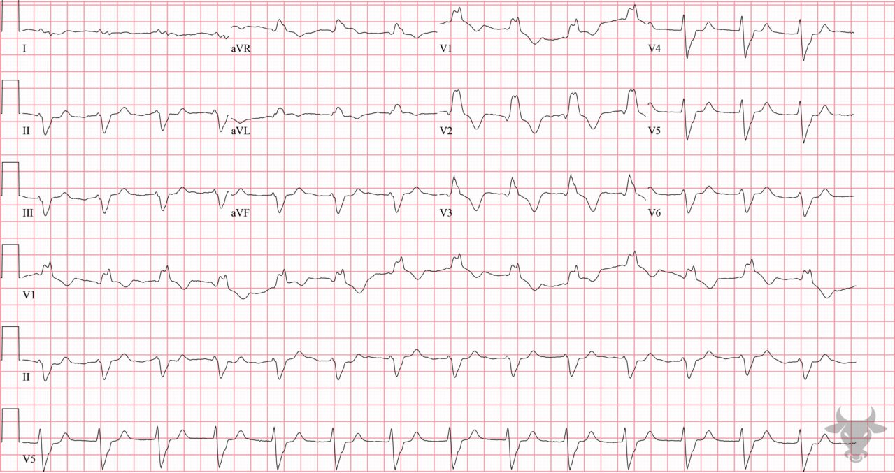 Left Anterior Fascicular Block | ECG Stampede