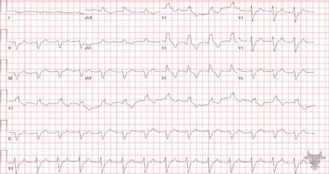 Right Bundle Branch Block | ECG Stampede
