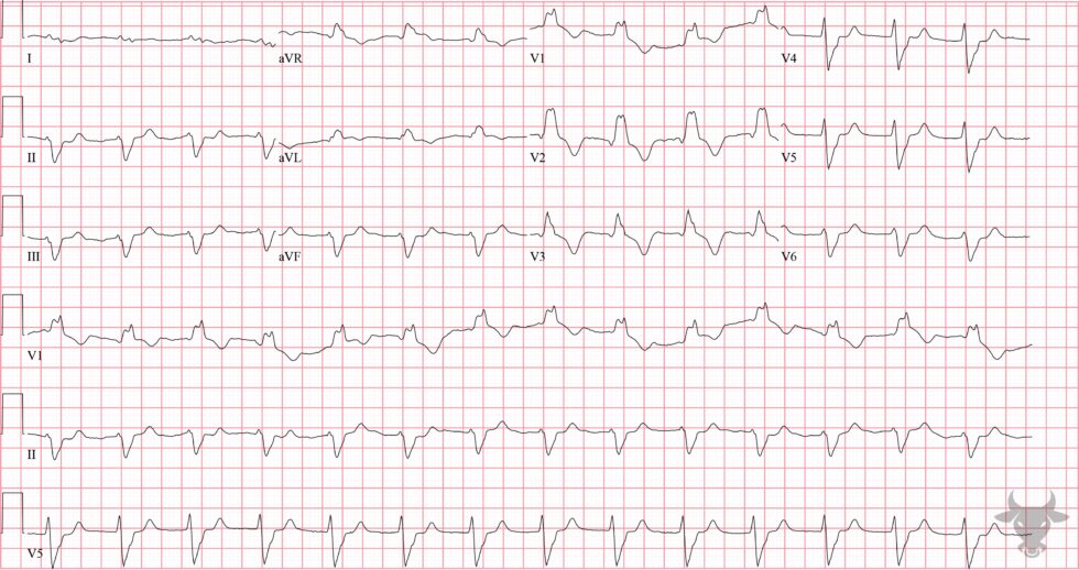 Right Bundle Branch Block | ECG Stampede
