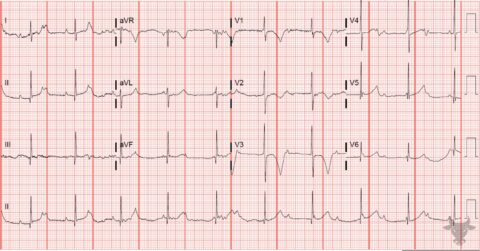 Third Degree Atrioventricular Block | ECG Stampede