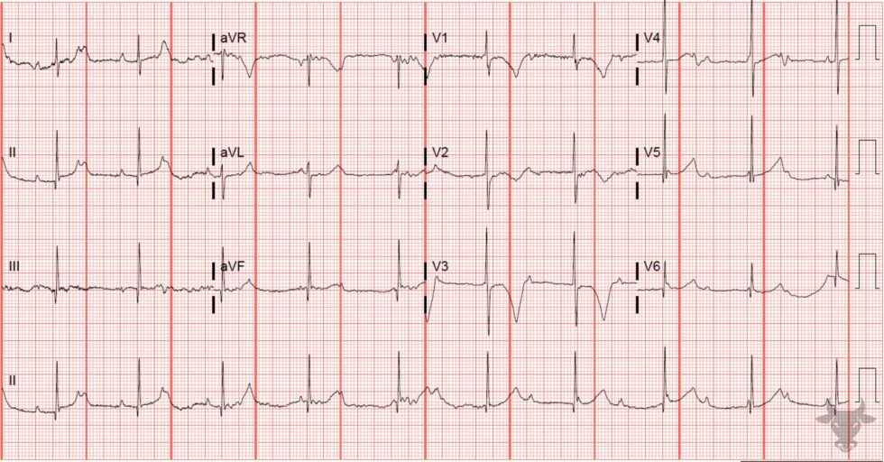 Third Degree Atrioventricular Block | ECG Stampede