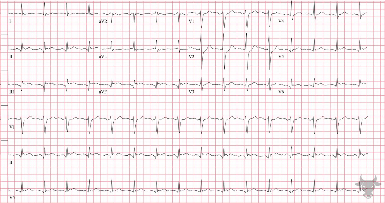 ST-elevation Myocardial Infarction | ECG Stampede