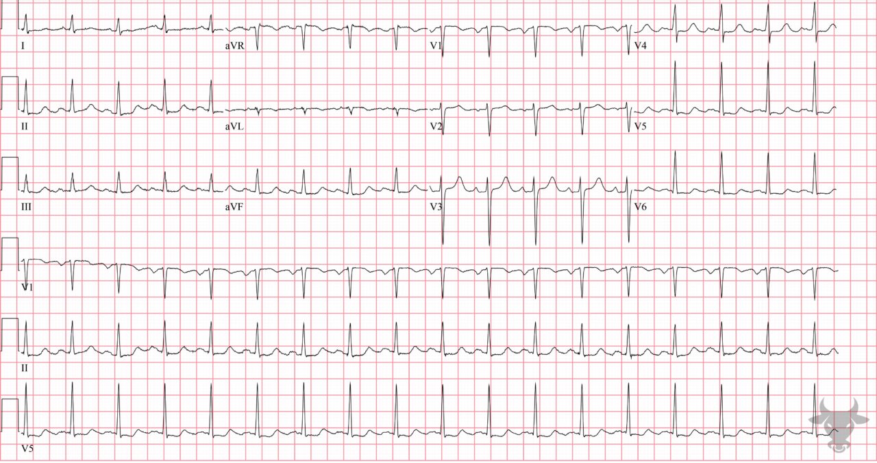 Global Subendocardial Ischemia | ECG Stampede