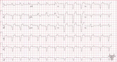 Left Bundle Branch Block | ECG Stampede