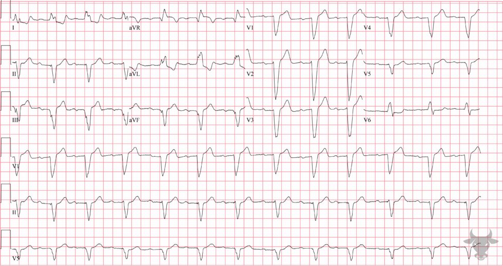 Left Bundle Branch Block | ECG Stampede