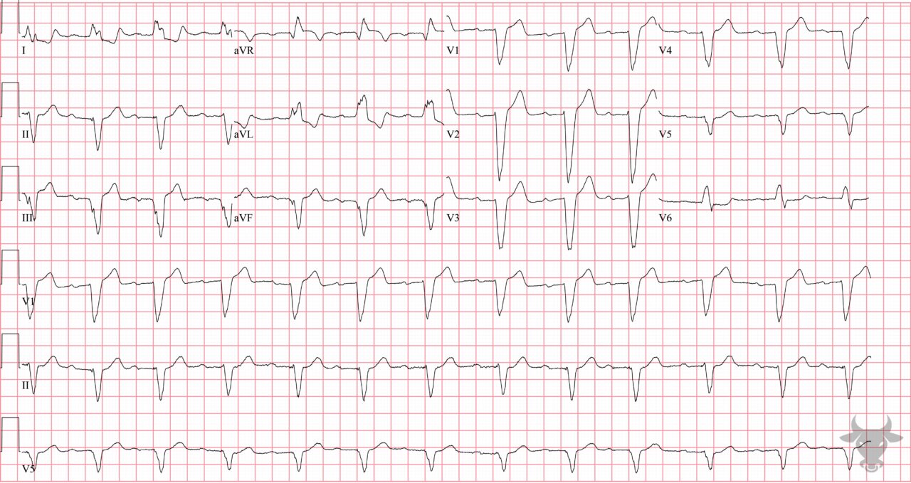 First Degree Atrioventricular Block | ECG Stampede