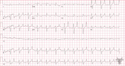 Hyperkalemia | ECG Stampede