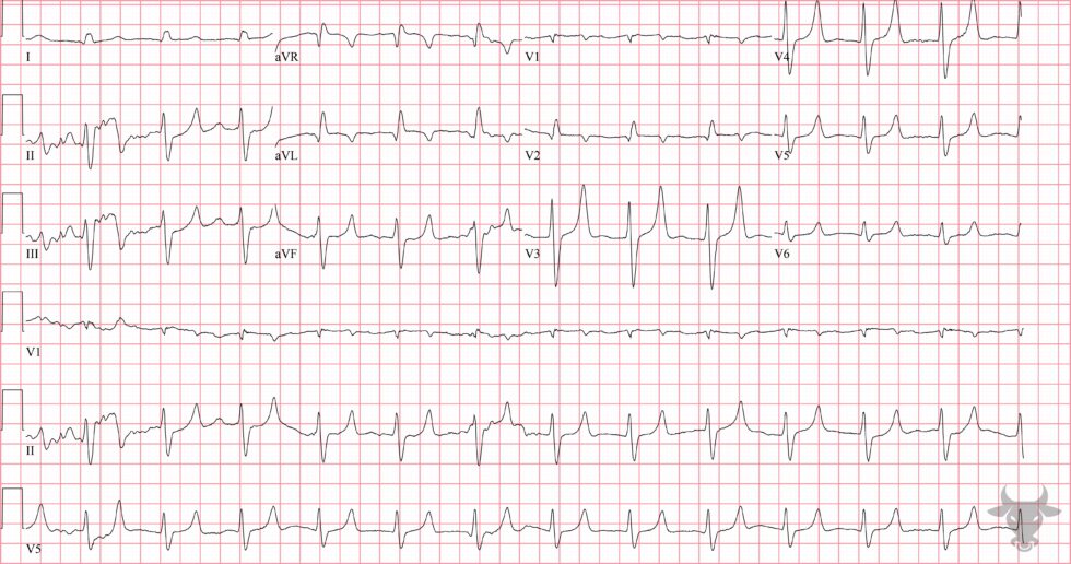 Hyperkalemia | ECG Stampede