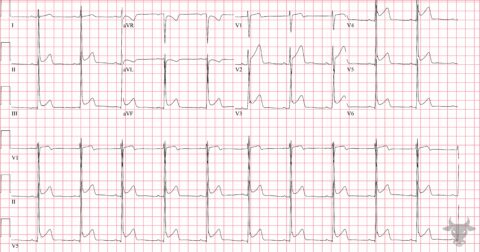 Early Repolarization | ECG Stampede