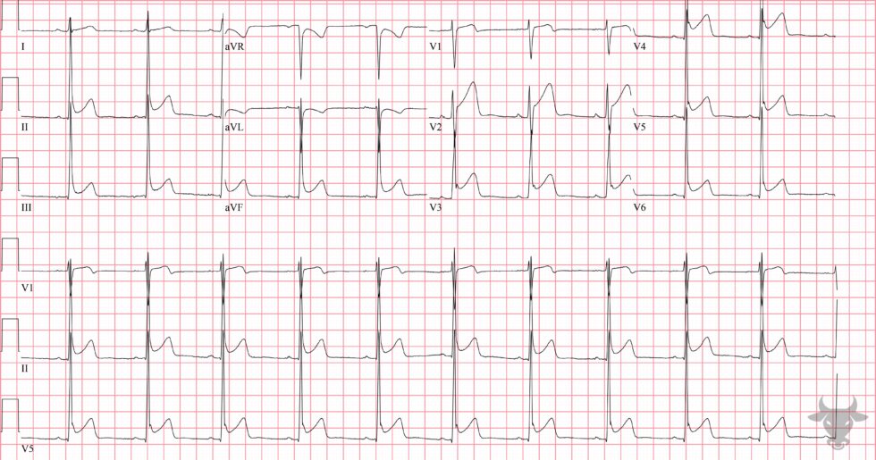 Early Repolarization | ECG Stampede