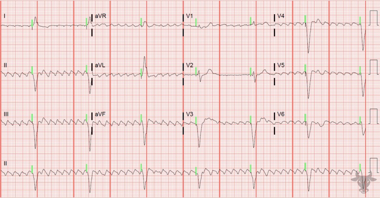 Atrial Flutter | ECG Stampede