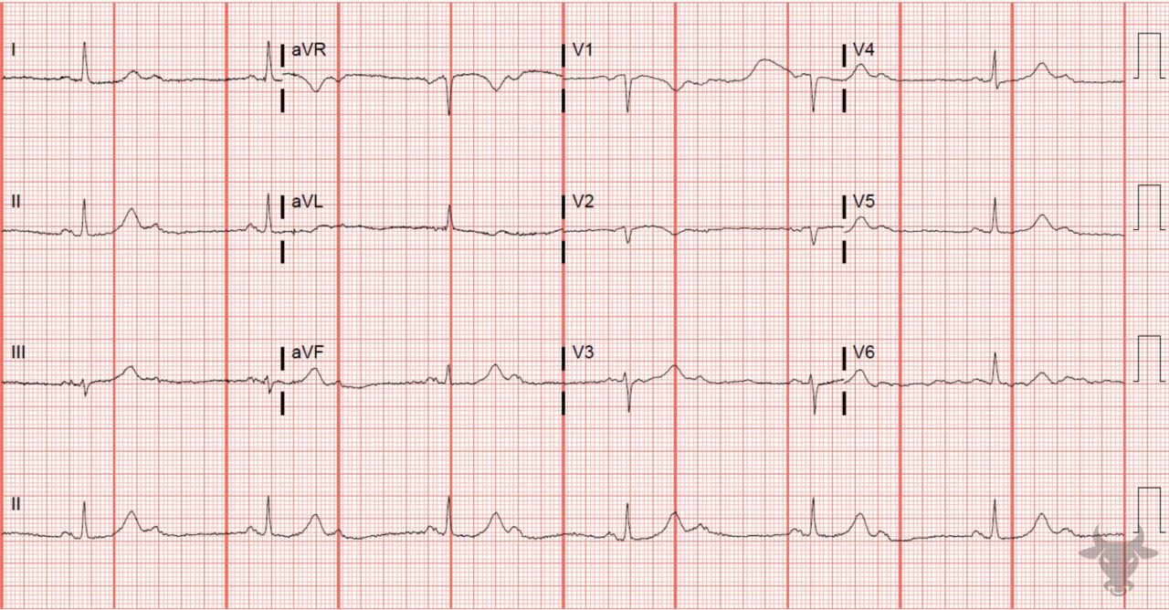 Second Degree Atrioventricular Block 2:1 | ECG Stampede