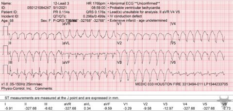 Ventricular Tachycardia | ECG Stampede