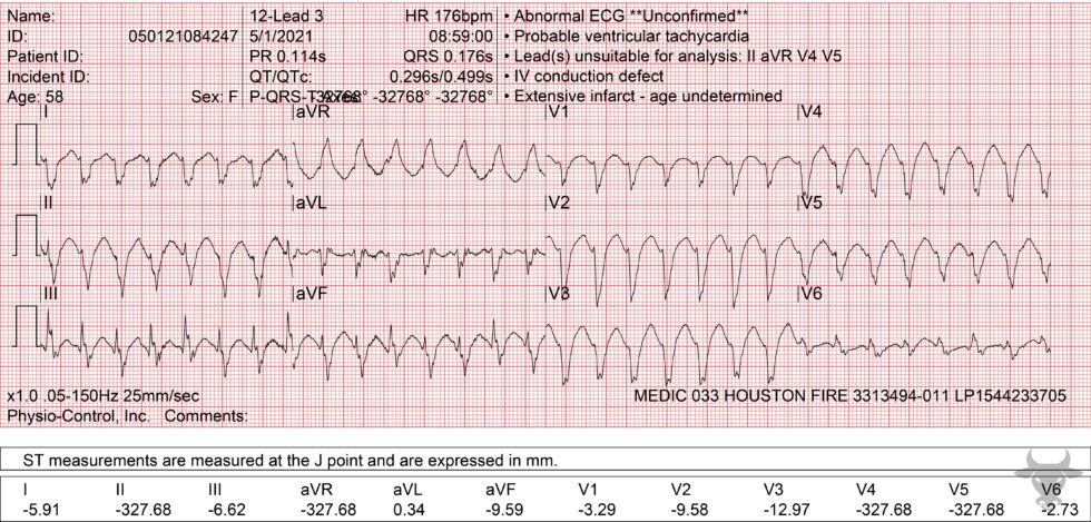 Ventricular Tachycardia | ECG Stampede