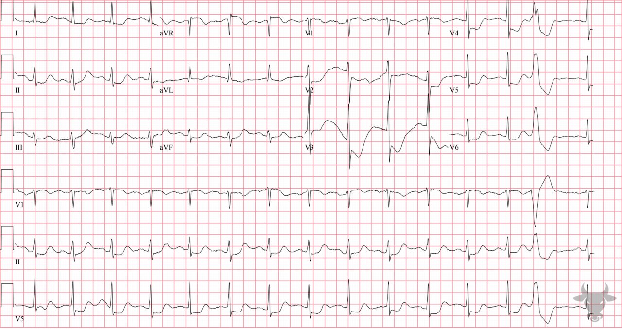 Global Subendocardial Ischemia | ECG Stampede