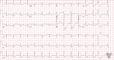 Global Subendocardial Ischemia | ECG Stampede