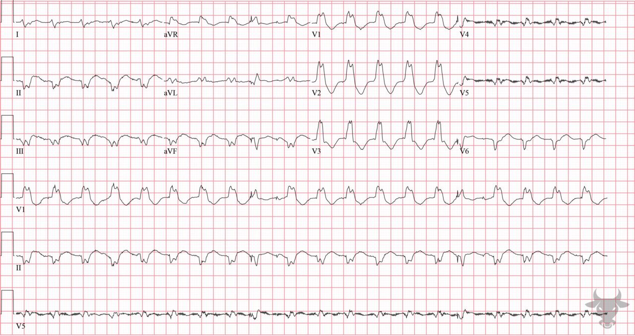 Ventricular Tachycardia | ECG Stampede