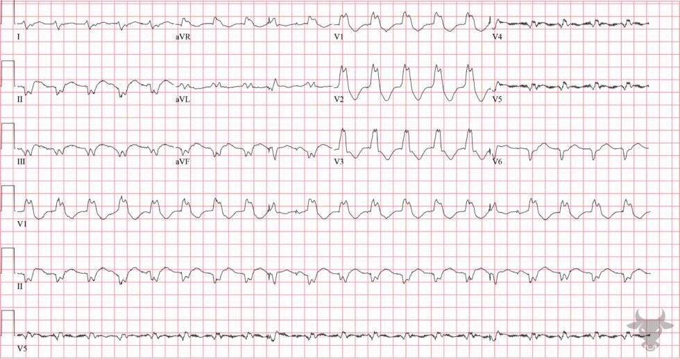 Ventricular Tachycardia | ECG Stampede