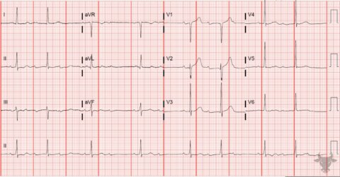 Second Degree Atrioventricular Block – Mobitz I | ECG Stampede