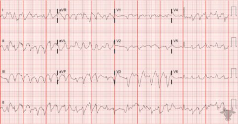 Left Bundle Branch Block | ECG Stampede
