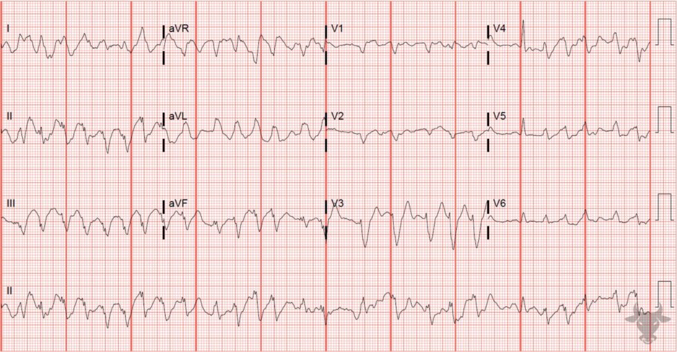 Left Bundle Branch Block | ECG Stampede