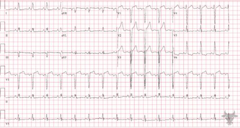 Left Ventricular Hypertrophy | ECG Stampede