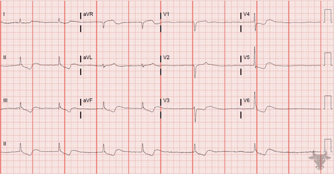 Digoxin Toxicity | ECG Stampede