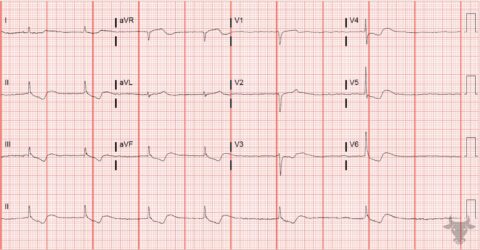 Digoxin Toxicity | ECG Stampede