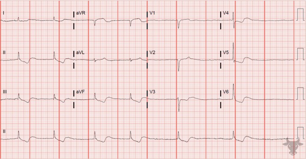 Digoxin Toxicity | ECG Stampede