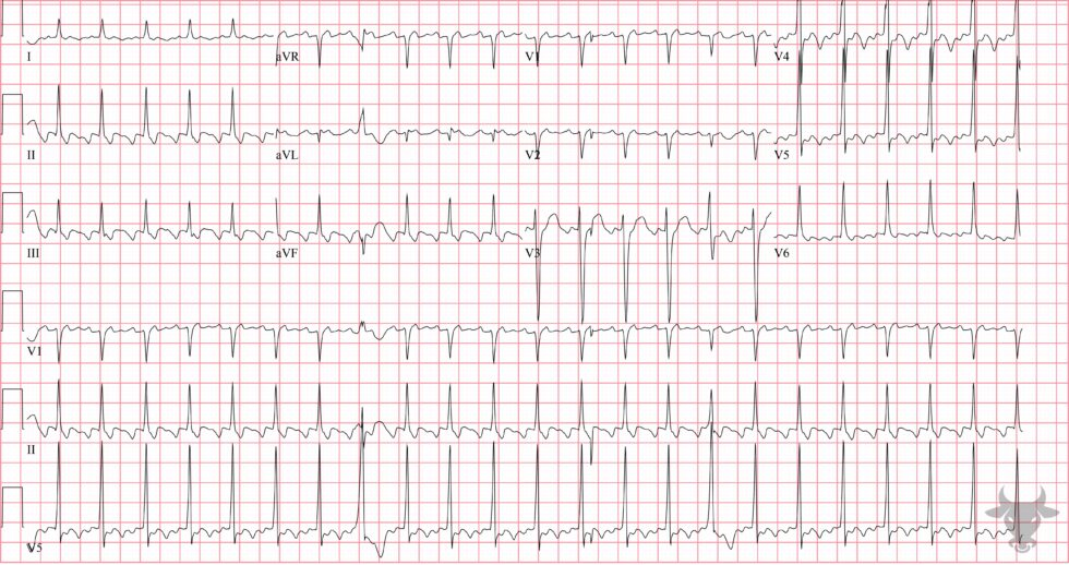 Atrial Flutter | ECG Stampede