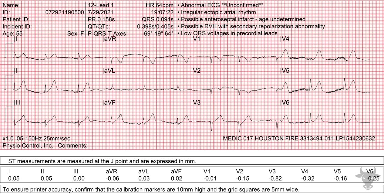 ST-elevation Myocardial Infarction | ECG Stampede