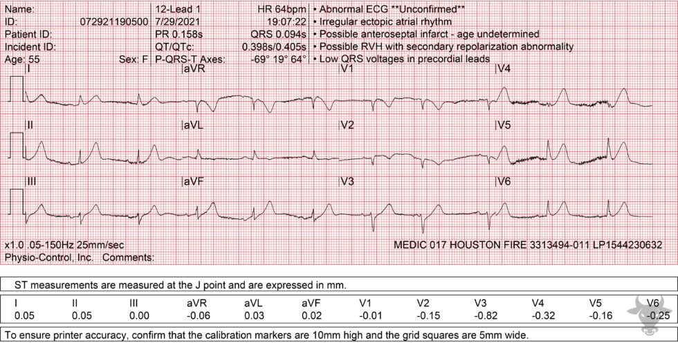 ST-elevation Myocardial Infarction | ECG Stampede