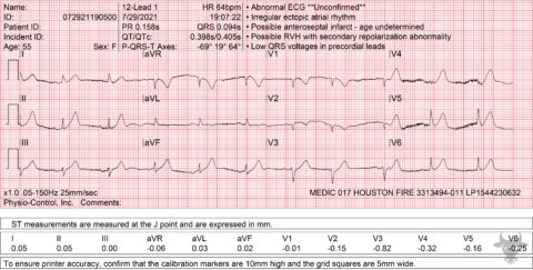 Hyperacute T Waves | ECG Stampede
