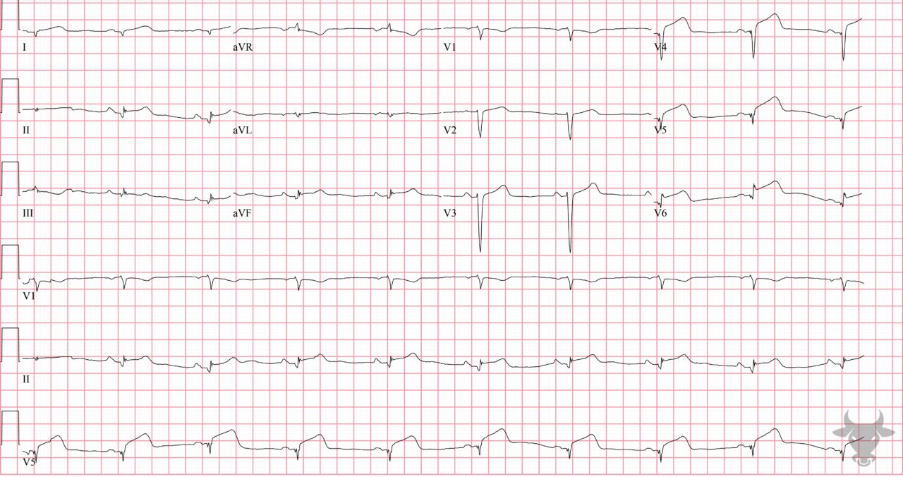 ST-elevation Myocardial Infarction | ECG Stampede