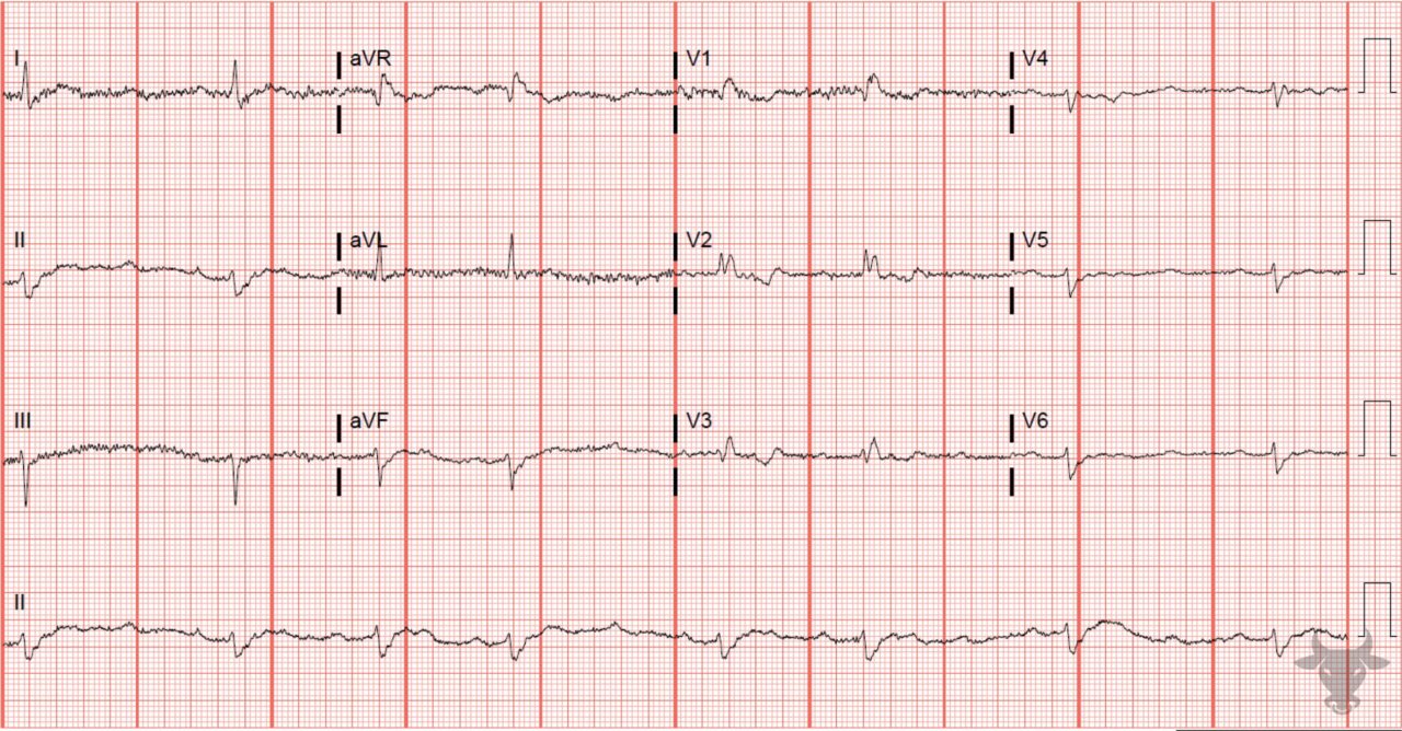 Second Degree Atrioventricular Block – Mobitz II | ECG Stampede