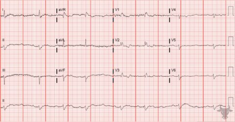 Second Degree Atrioventricular Block – Mobitz II | ECG Stampede