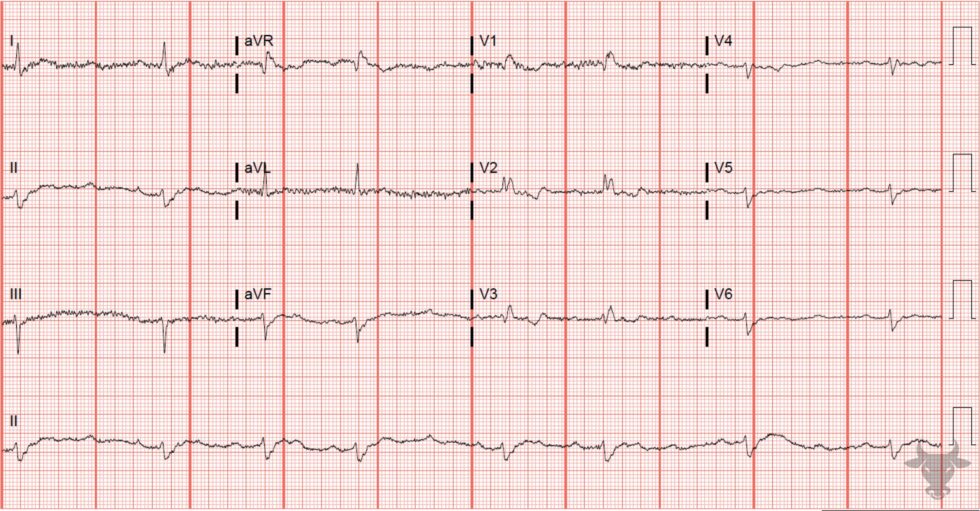 Second Degree Atrioventricular Block – Mobitz II | ECG Stampede